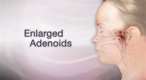 Swollen Adenoids In Nose