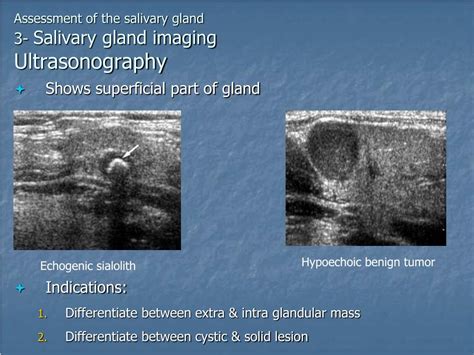 Ppt Salivary Gland Disease Powerpoint Presentation Free Download Id3046876