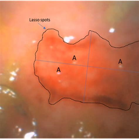 Example For Preparing The Endoscopic Image For Software And Image