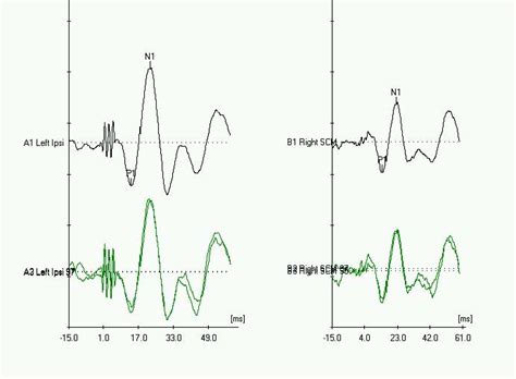Vemp Testing And Hearing