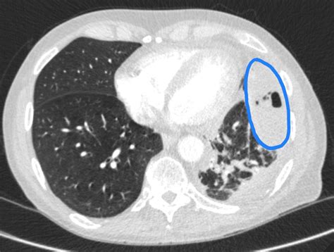 Empyema Ct Axial Annotated Jetem 2021 Jetem