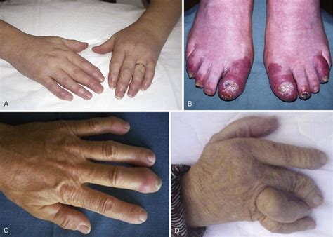Psoriatic Arthritis Musculoskeletal Key