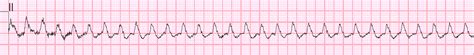 Telemetry And Ekg Basics Rhythm Recognition