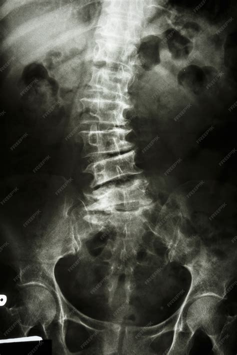 Scoliose Film Radiographie De La Colonne Vertébrale Lombaire Vue De