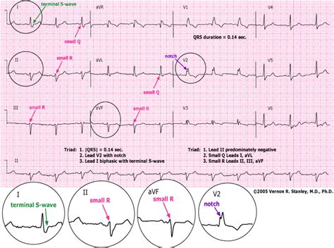 Ecg Case Study Practice Quiz
