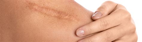 Tipos de cicatrices Clínica Dávila