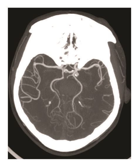 Axial Cerebral Cta Image Showing Bilateral Fetal Pca With Right P1 Download Scientific Diagram