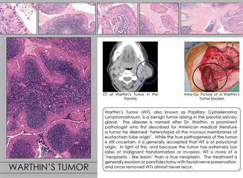 Warthins Tumor Iowa Head And Neck Protocols