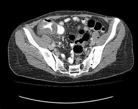 Post Polypectomy Syndromea Rare Complication In Colonoscopy Procedures A Case Report PMC