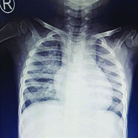 Chest X Ray Showing Bilateral Reticular Shadows Download Scientific