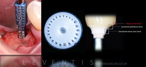 The Cervico System On Adjacent Molars — Cervico By Vpi