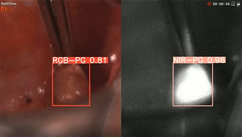 A New Imaging Device With Ai May Reduce Complications During Thyroid