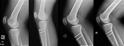 Prominent Tibial Tuberosity