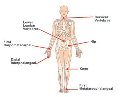 Rheum Flashcards Quizlet
