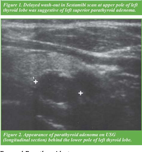 Figure 2 From Primary Hyperparathyroidism A Surgeon S Perspective Semantic Scholar