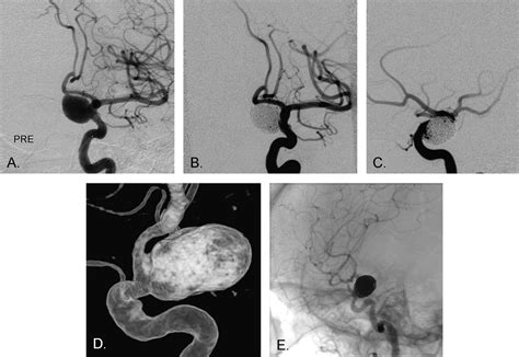 Stent Assisted Coiling Of Paraclinoid Aneurysms Risks And Effectiveness Journal Of