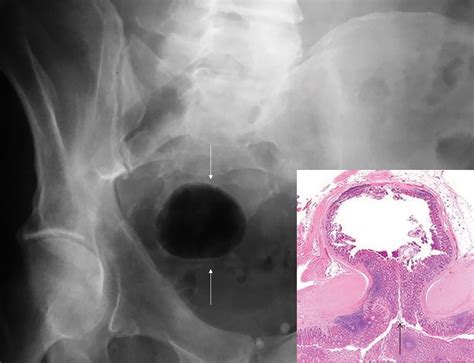 Giant Sigmoid Diverticulum Imaging Features And Management Applied