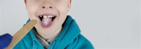 Imágenes De Tongue Disease Descubre Bancos De Fotos Ilustraciones