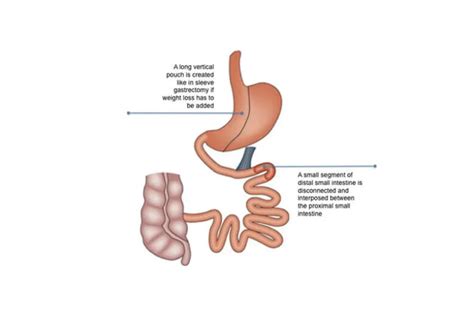 Home Revision Bariatric Surgery