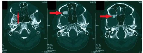 Brain Ct Bone Window Level Of Orbital Cavity Axial Images Image