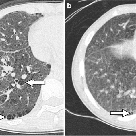 Lymphoid Interstitial Pneumonia Lip Histopathology An 8 Year Old Download Scientific Diagram