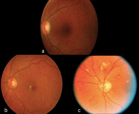 Representative Photos Of The Different Stages Of Retinopathy In The