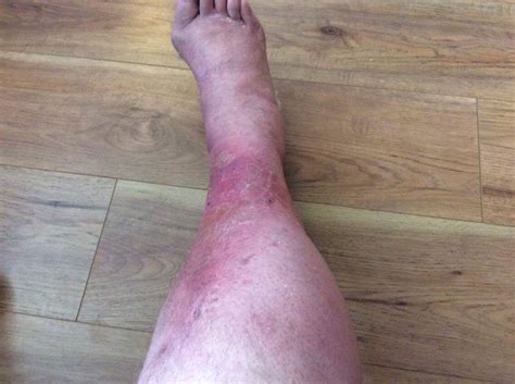 Curing Cellulitis Permanently The Pantry Pharmacy