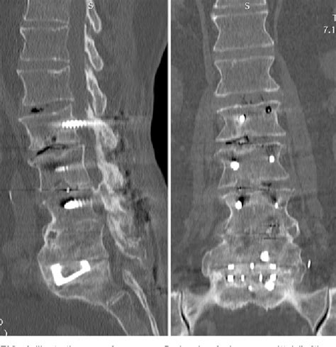 Figure 1 From The Anterior To Psoas Approach For Interbody Fusion At The L5 S1 Segment Clinical