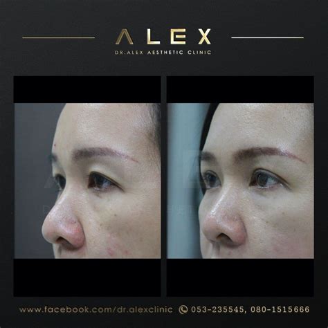 Pin By Dralex Aesthetic Clinic On Thailand Plastic Surgery Aesthetic