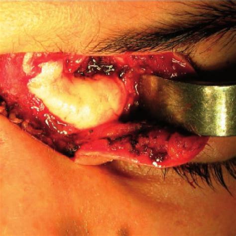Aspect Of The Ethmoidal Osteoma In Patient 1 Before Resection