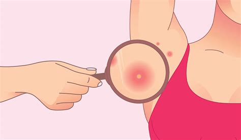 Folliculitis What Is Causes Symptoms Treatment And Prevention