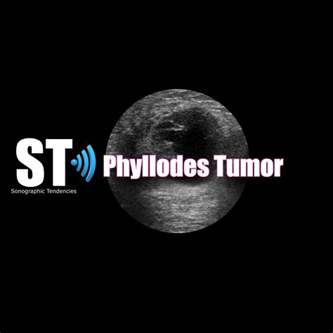 Phyllodes Tumor Sonographic Tendencies