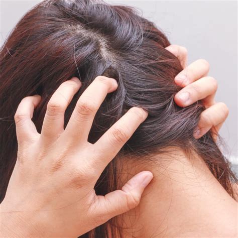 Best Home Remes For Scalp Ringworm Homemade Ftempo