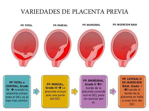 Tipos De Placenta Previa Y Sus Diferencias Tipos De Placenta Previa Y