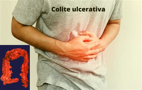 Colite Ulcerativa Sintomas Causas E Tratamento
