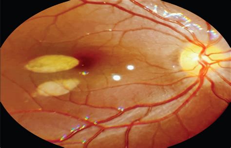Torpedo Maculopathy With Double Torpedoes Indian Journal Of Ophthalmology
