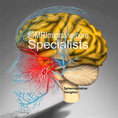 Sphenopalatine Nerve Block
