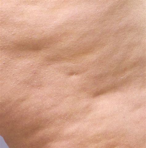 Cellulitis Treatment