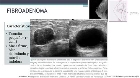 Lesiones Benignas De La Mamaaaaaaaaaaaaa Pptx Cancer Diseases And