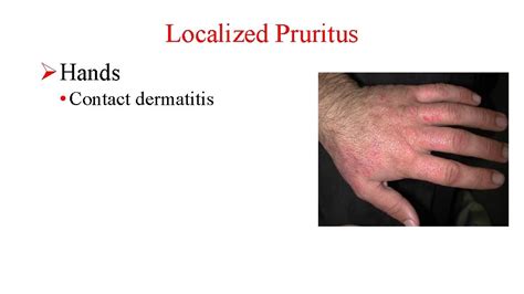 Localized Pruritus Scalp Psoriasis Localized Pruritus Scalp Psoriasis