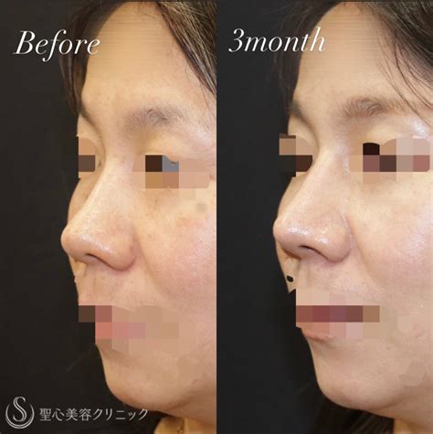 【30代女性・鼻筋から鼻先まで洗練された美しさを】プロテーゼによる隆鼻術鼻尖縮小鼻尖形成（耳介軟骨移植）（3ヶ月後） 症例写真