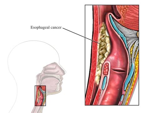 Esophageal Cancer Cause Risk Factors And Prevalence