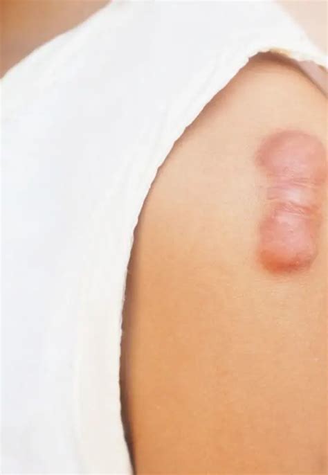 Steroid Injection For Scars London Drs Tatiana Rishi Advanced