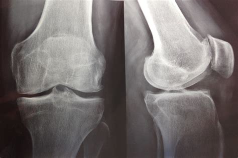 Artrosis De Rodilla