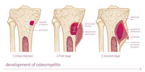 كشف التهاب العظم والنقي Osteomyelitis شعاعياً موقع فكين