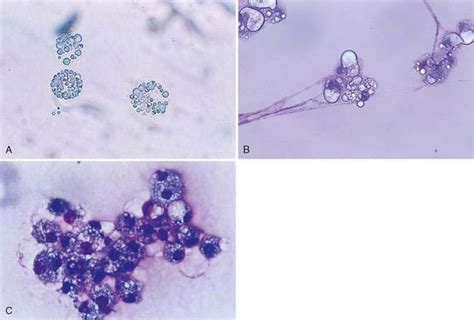 Stain Precipitate In Urine