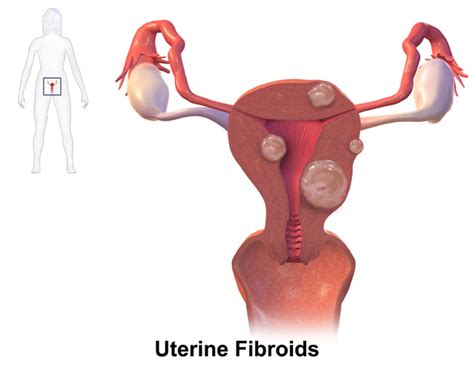 Difference Between Polyps And Fibroids Difference Between