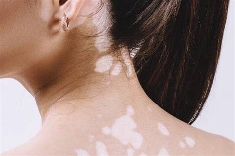 Vitiligo Gejala Penyebab Pengobatan Dll Hello Sehat