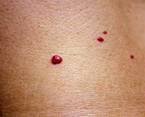 Little Red Spots On Chest