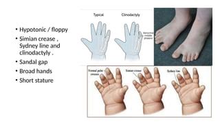 Downs Syndrome Clinical Features And Management Pptx